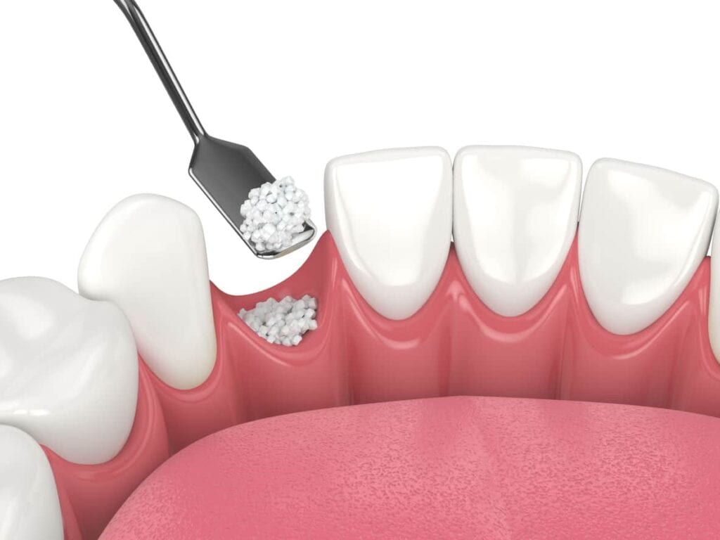 Bone or gum grafting | Centre dentaire et d’implantologie LaSalle
